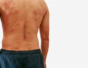 Sofa Dermatitis