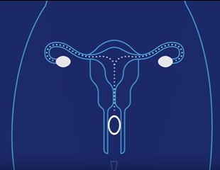 Long-Acting Reversible Contraception (LARC) Types