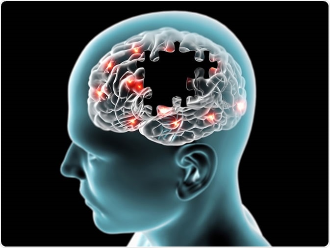 Alzheimer’s Disease | Definition, Causes, Diagnosis & Treatment