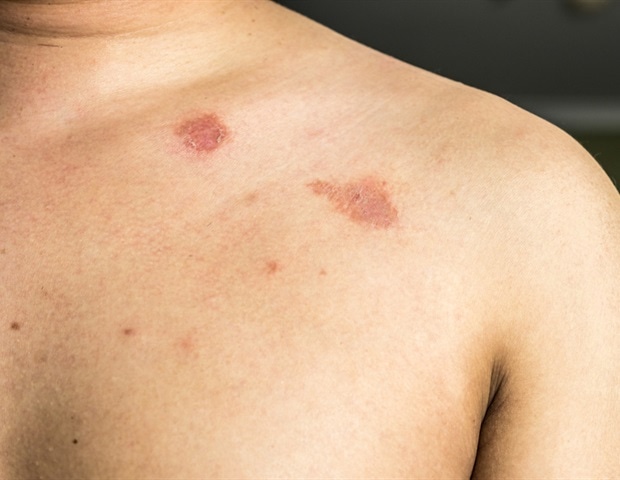 ringworm in adults causes