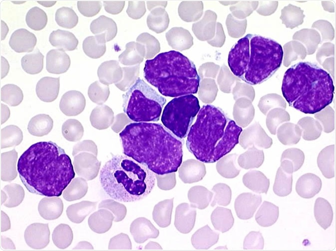 What is Sézary Syndrome?