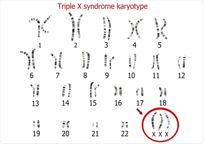 What is Triple X Syndrome?