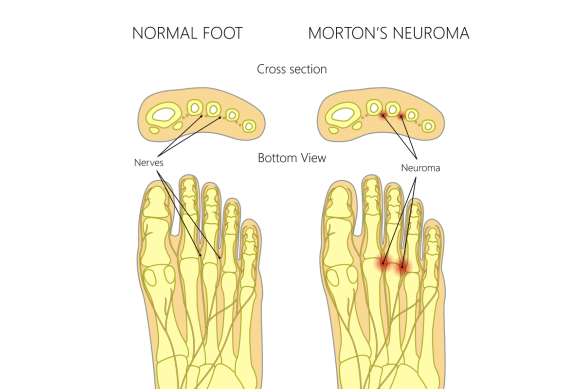 What is Morton's Neuroma?