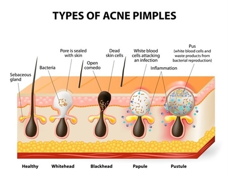 Types of Spots, Pimples