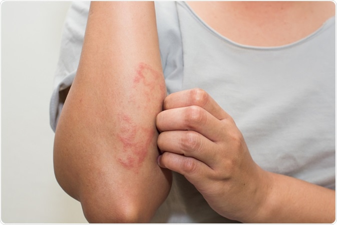 Differentiating Between Eczema and a Rash