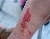 cutaneous vasculitis dermnet