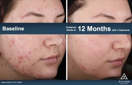 Accure Acne secures FDA clearance for long-term acne solution