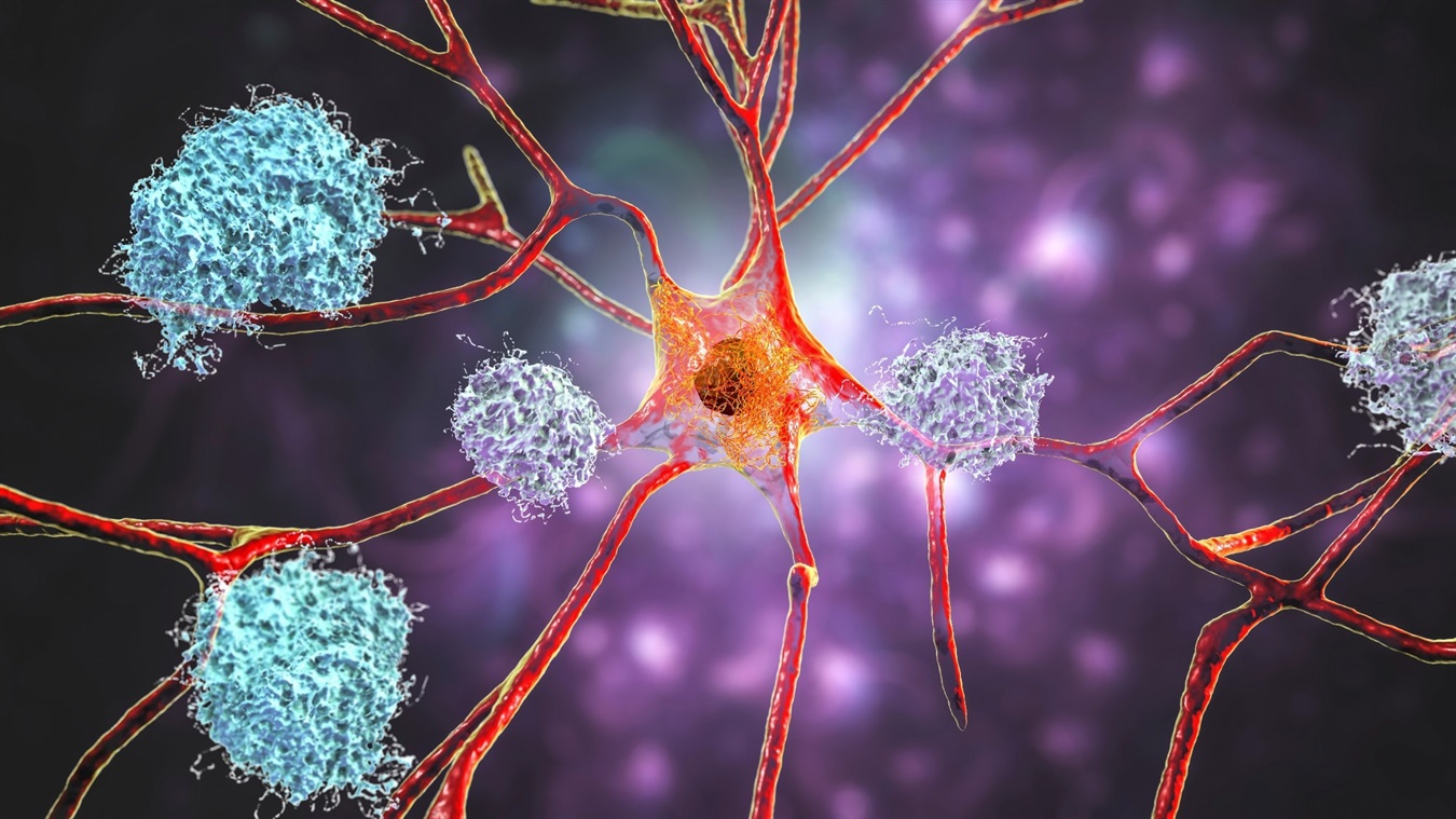 Dual cancer drugs restore memory and rewire brain cells in Alzheimer’s ...