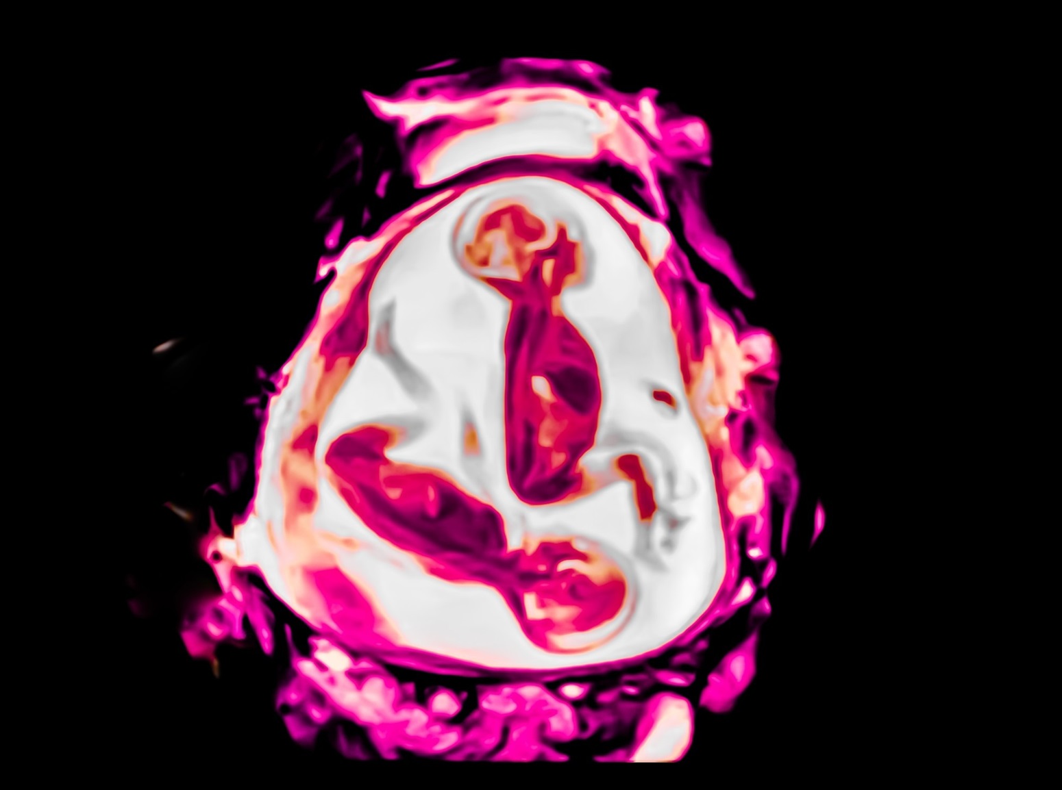 MRI scans reveal human brain growth from pregnancy through birth