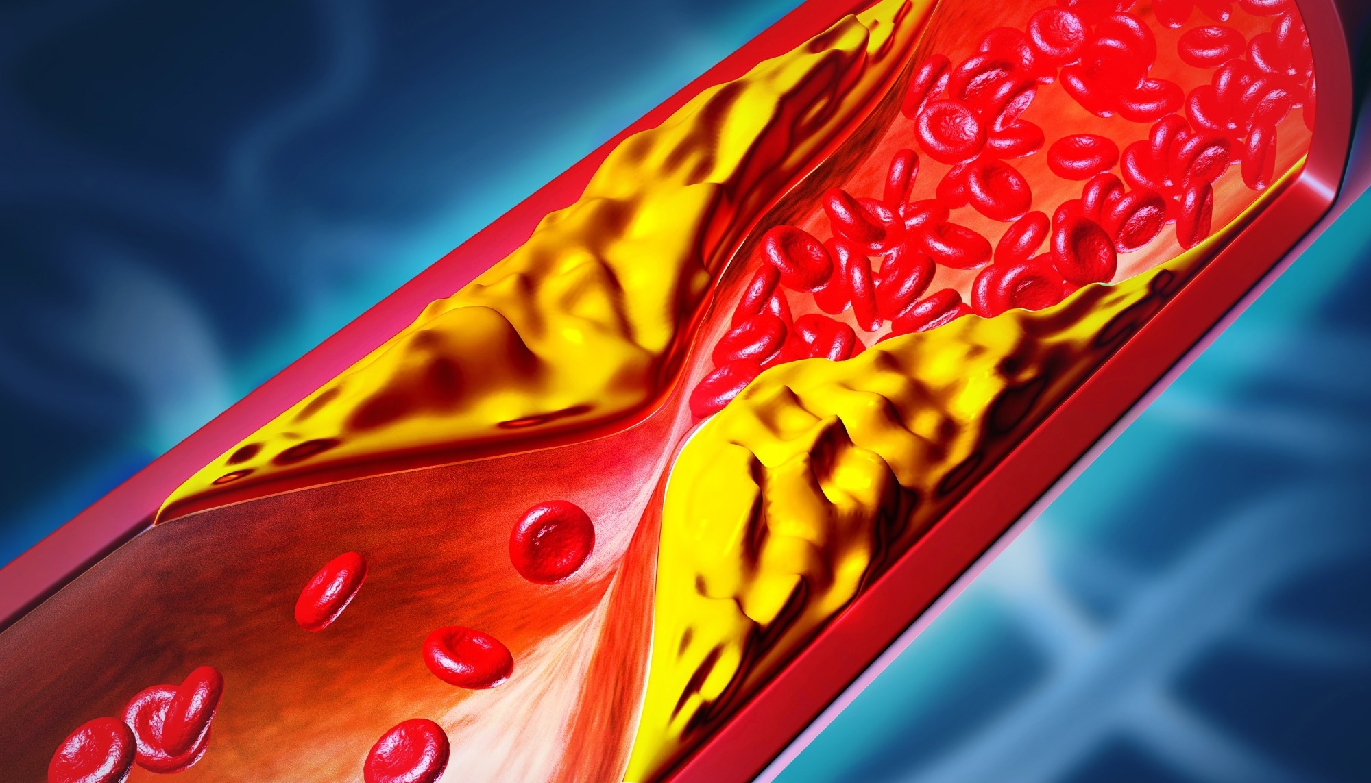 One-time gene editing cuts LDL cholesterol in early ...