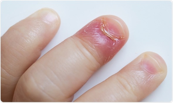 Types of Nail Disease