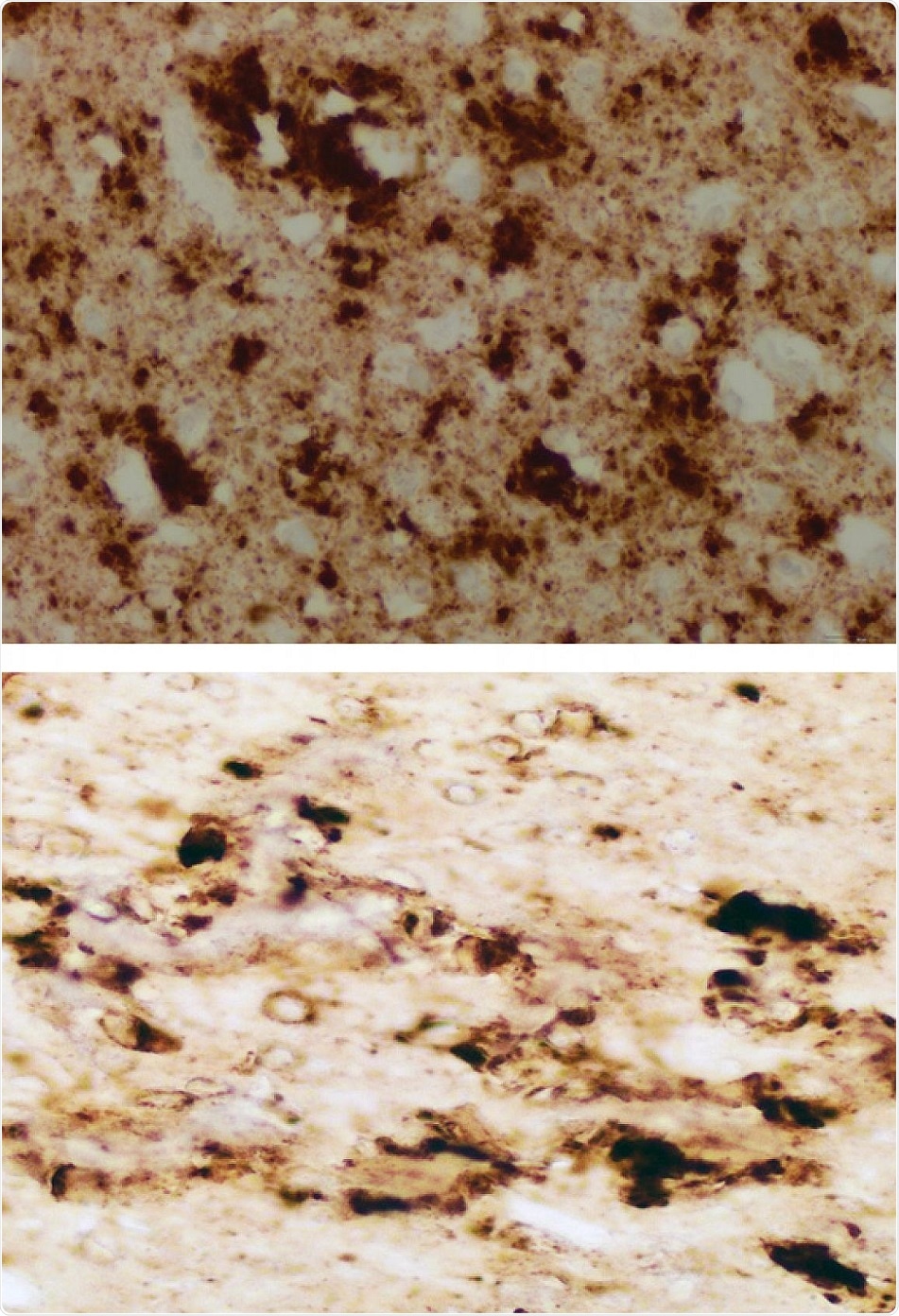 Scientists detect pathological prion protein in skin of CJD patients