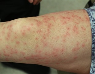 Irritant vs Allergic Contact Dermatitis