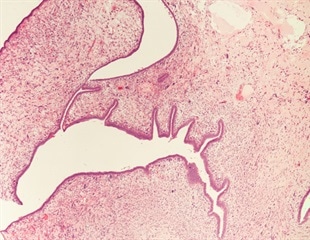 Radiotherapy and Chemotherapy for Phyllodes Tumors
