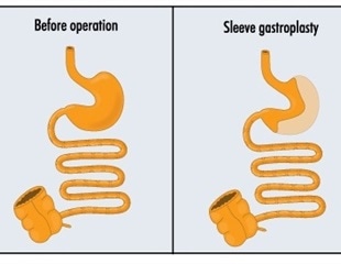 Complications of Sleeve Gastrectomy