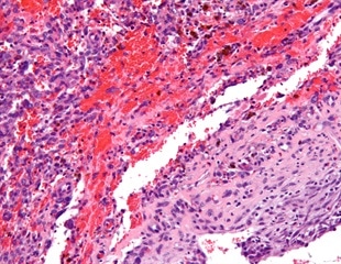 Dermatofibroma Diagnosis and Differential Diagnosis