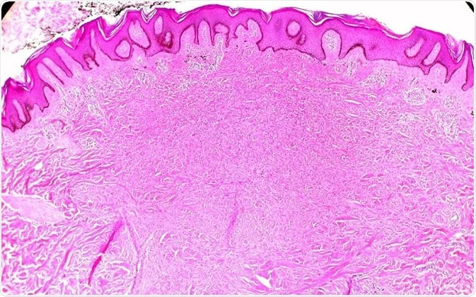 Dermatofibroma Presentation
