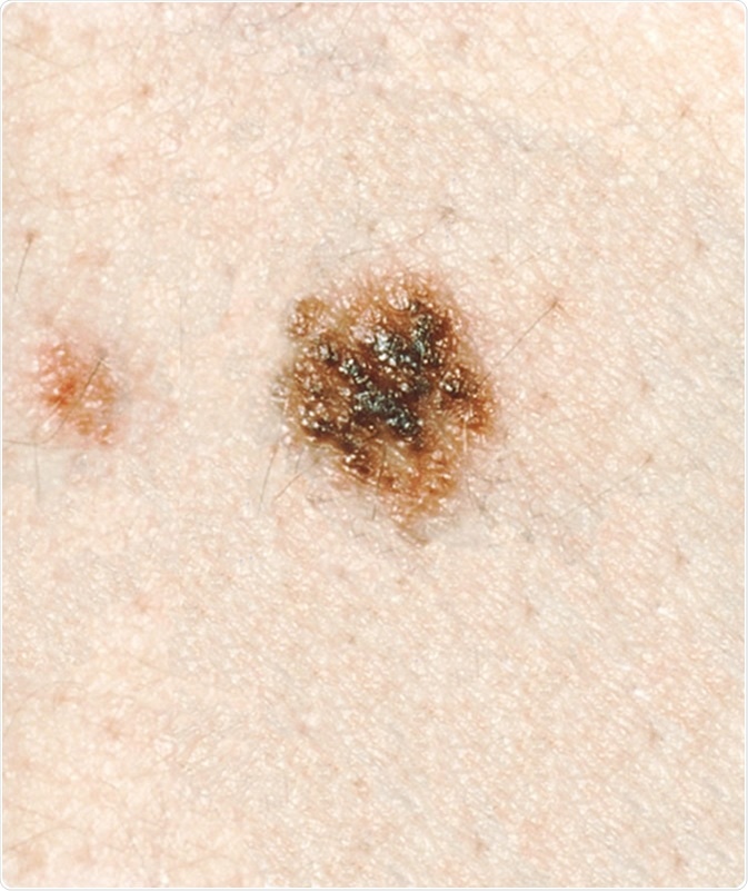 Dysplastic Nevi (Atypical Moles)