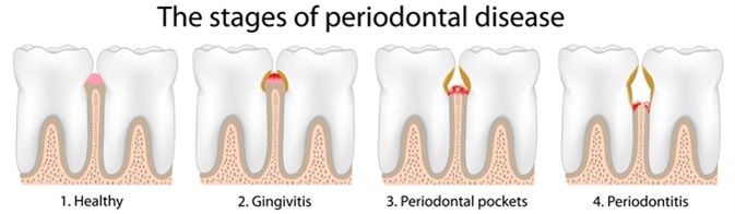 Management of Periodontitis
