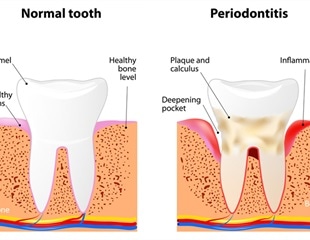 Prevention of Periodontitis