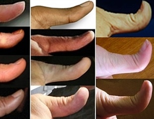 Genetics of Hitchhiker's Thumb