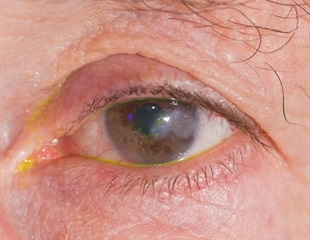 How is Keratitis Diagnosed?