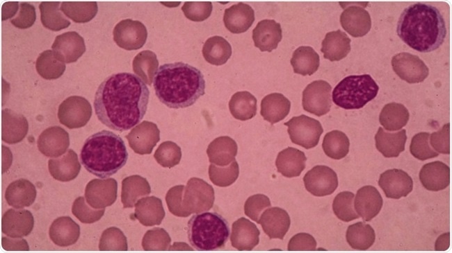 Chronic Lymphocytic Leukemia Causes