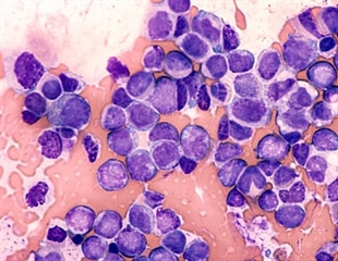 Types of Blood Cancer