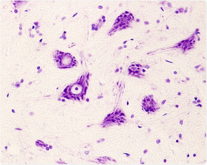 Spinal Muscular Atrophy Causes