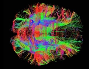 Diffusion Tensor Imaging (DTI) Explained
