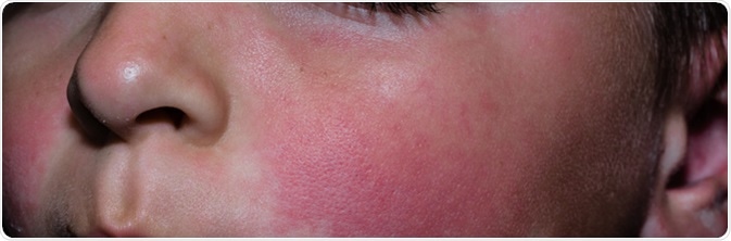 Fifth Disease Diagnosis and Treatment