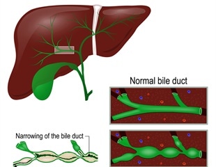 What is Acute Cholangitis?