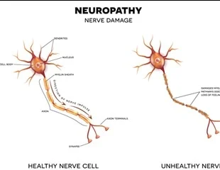 Small Fiber Neuropathy Symptoms and Causes