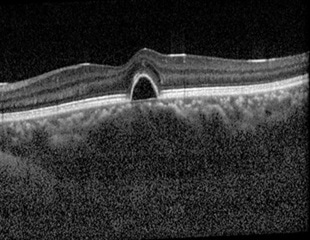 What is Optical Coherence Tomography?