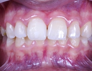 What is Tooth Remineralization?