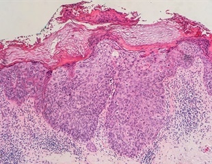 Bowen's Disease Signs and Symptoms