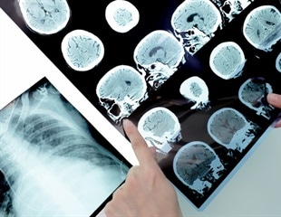 What is Psychosurgery?