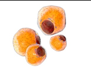 Lipodystrophy Causes