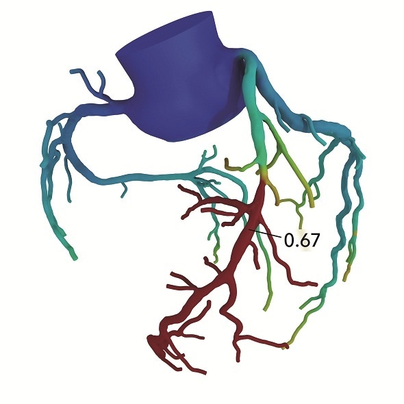 HeartFlow Analysis shows highest diagnostic performance for detecting ...