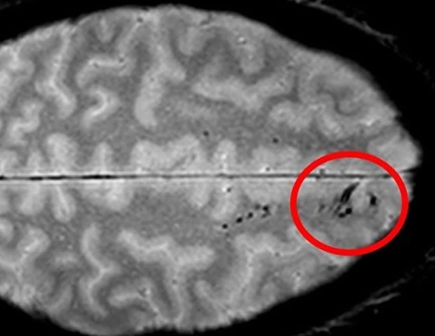 Study shows microbleeds after head injury signal danger to brain function