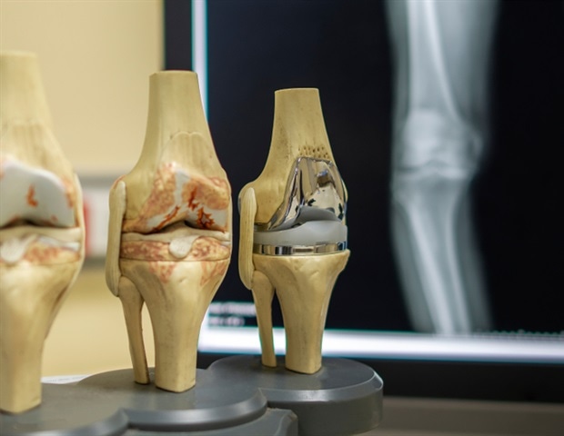Osteoarthritis Complications