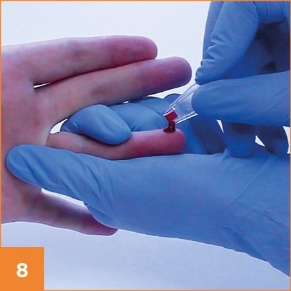 Relevance of Capillary Blood Sampling for Hemoglobin Results