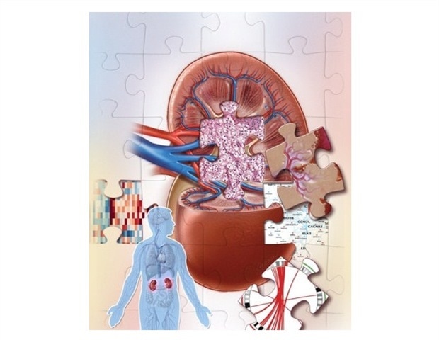 Researchers identify new kidney cancer subtypes and clues to better ...