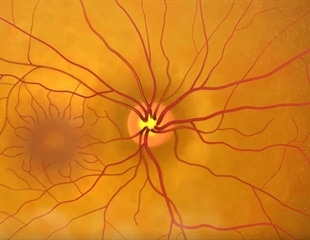 What is Normal-Tension Glaucoma?