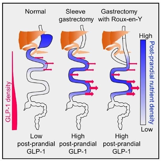 Bariatric surgery changes the way our body senses food