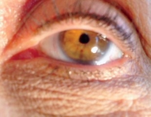 What is Iridodonesis?