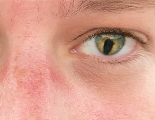 Treating and Managing Colobomas