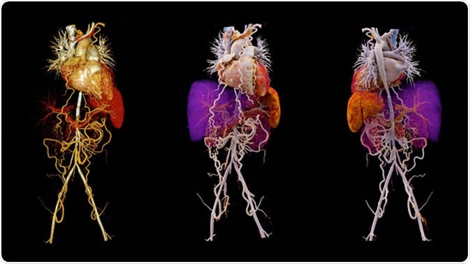 What is Takayasu Arteritis?