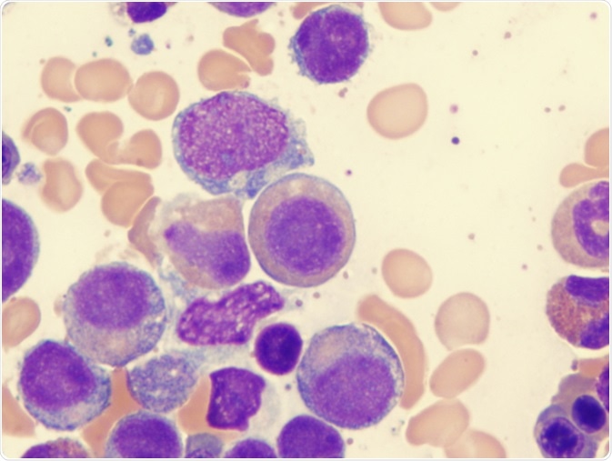 What are Myelodysplastic Syndromes?