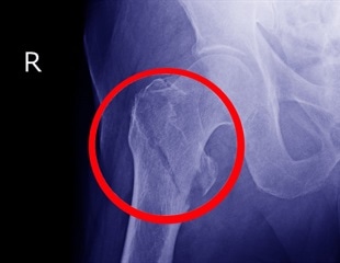 Experts explain what happens after hip fracture in older adults